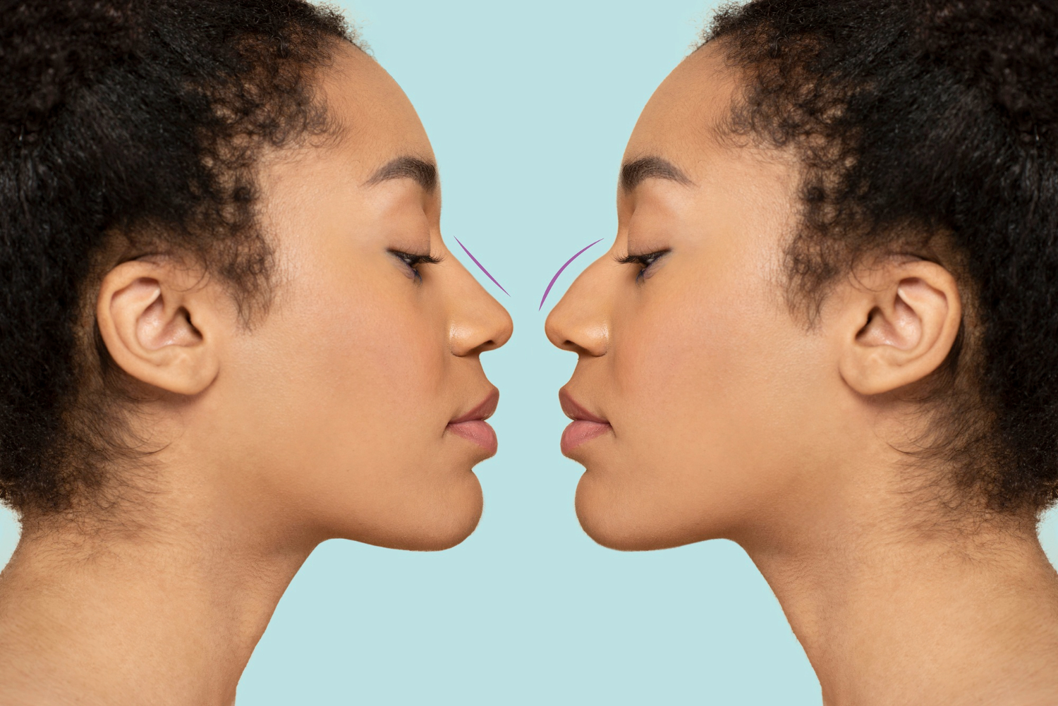 A rinoplastia ajuda nos sintomas da rinite? - Alexandre Andrade